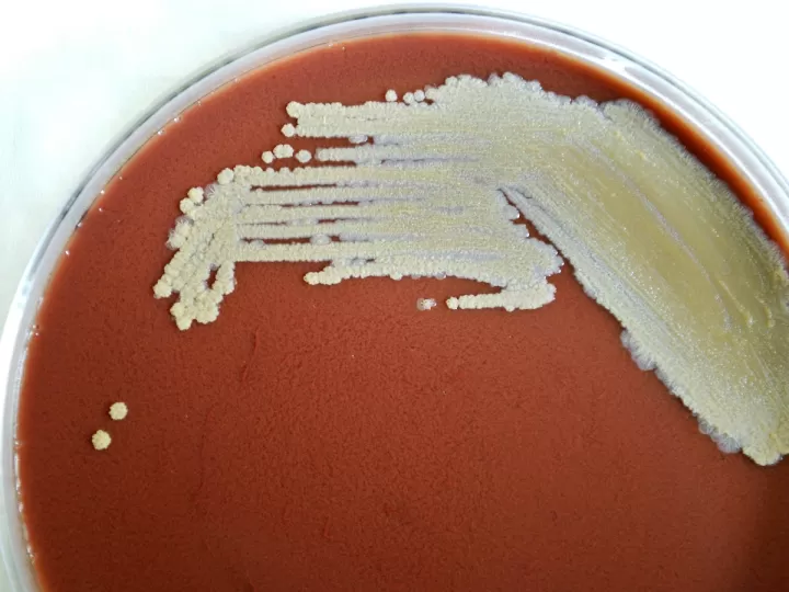 Todo lo que debes saber sobre el síndrome de Sudeck: causas ...